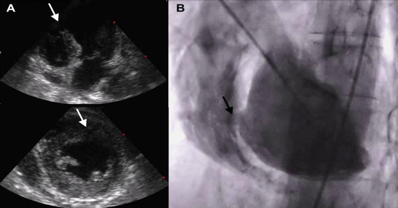 Treatment Approach for Post-Myocardial Infarction Ventricular Septal ...