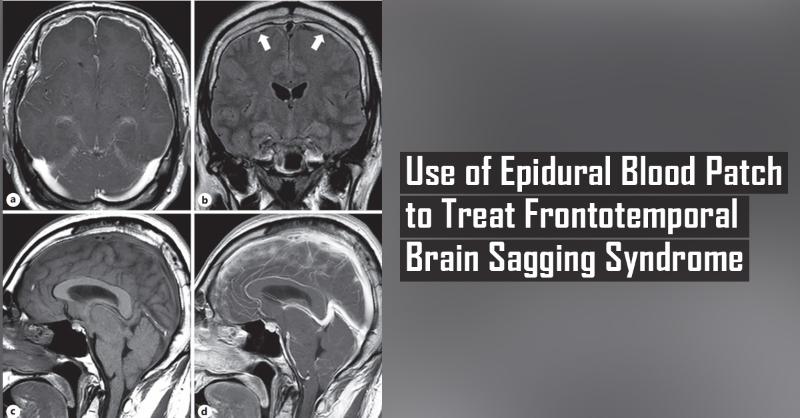 Application of Epidural Blood Patch in Treating a Frontotemporal Brain ...