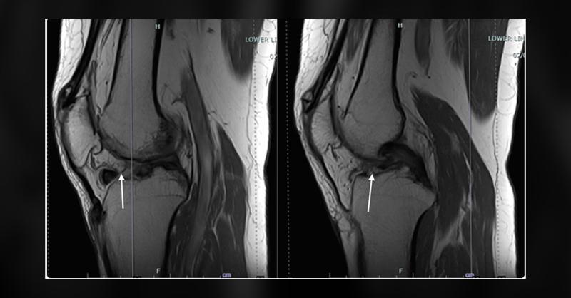Achieving Full Range of Motion for Knee Locking Due to Loose Bodies and ...
