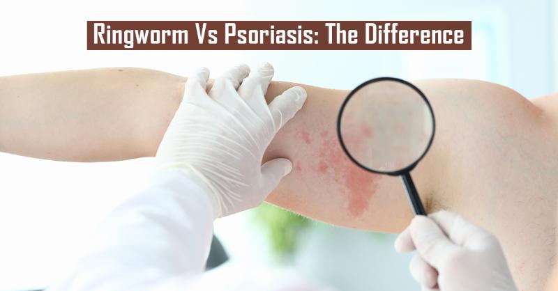 Physical Examination Factor for Distinguishing Psoriasis from Ringworm ...