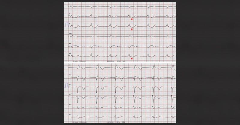 ECG Patterns in an Elderly Patient with Acute Non-ST Segment Elevation ...