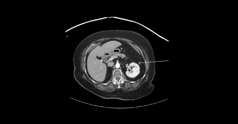 Case of Acute Renal Infarction and Cardioembolic Stroke in a Patient ...