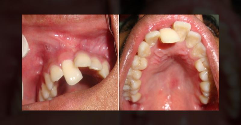 Maxillary Anterior Painless Swelling with Palatal Erosion and Central ...