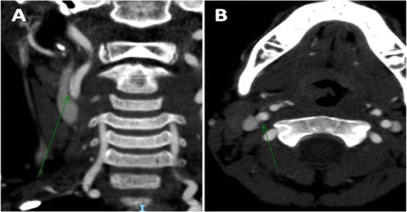 Identify The Condition in a Healthy Child Following a Blunt Intraoral ...