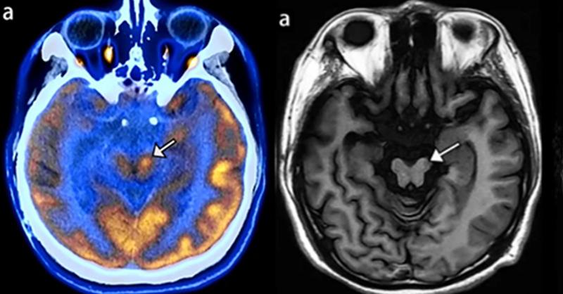 A Case Of Kernohan Woltman Notch Phenomenon Caused By An Epidural