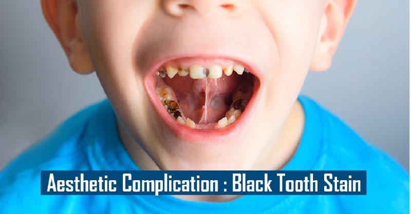 Black Tooth Stains in Children | MedSynapse