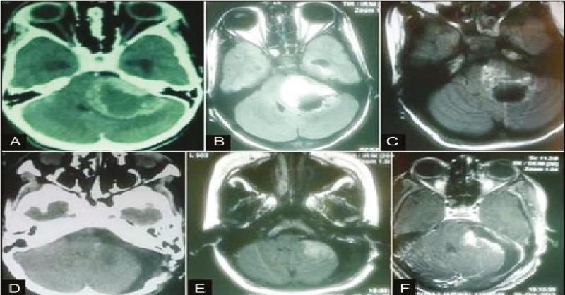 Intratumoral Hemorrhage in a Sporadic Vestibular Schwannoma in an 11 ...