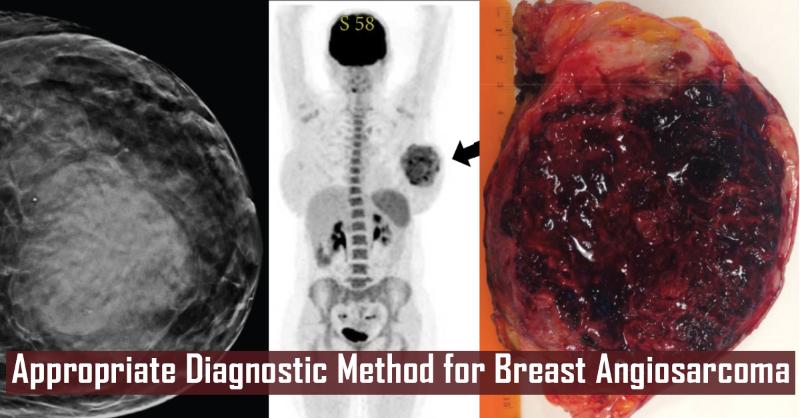 Diagnosis of Primary Breast Angiosarcoma | MedSynapse