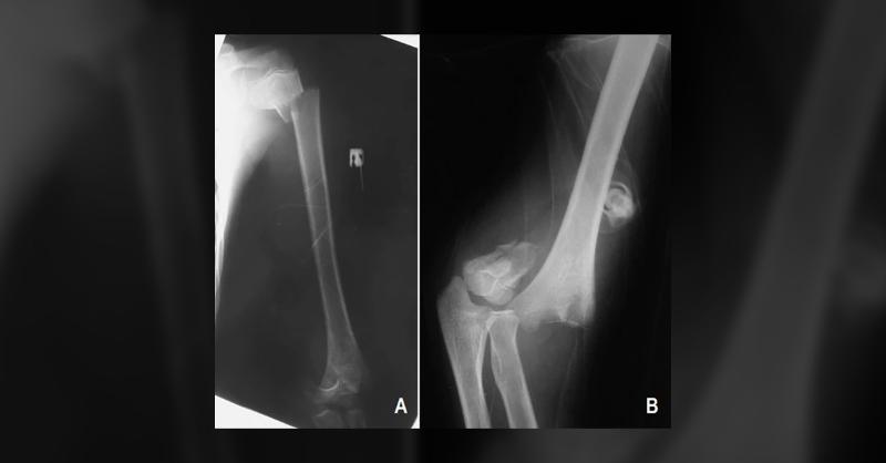 Boy with Fractures of the Proximal and Distal Parts of the Humerus ...