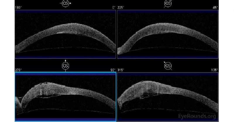 A 51-year-old male with Eye Redness, Pain, and Tearing in his Left Eye ...