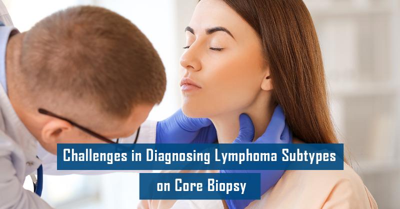 Pitfalls in Diagnosing Lymphoma Subtypes on Core Biopsy | MedSynapse
