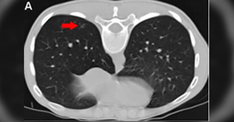 The hemorrhagic shock caused by preoperative computed tomography‑guided ...