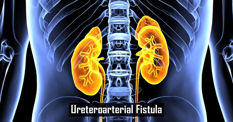 Ureteroarterial Fistula: A Diagnosis Which Is Not Always Black and ...