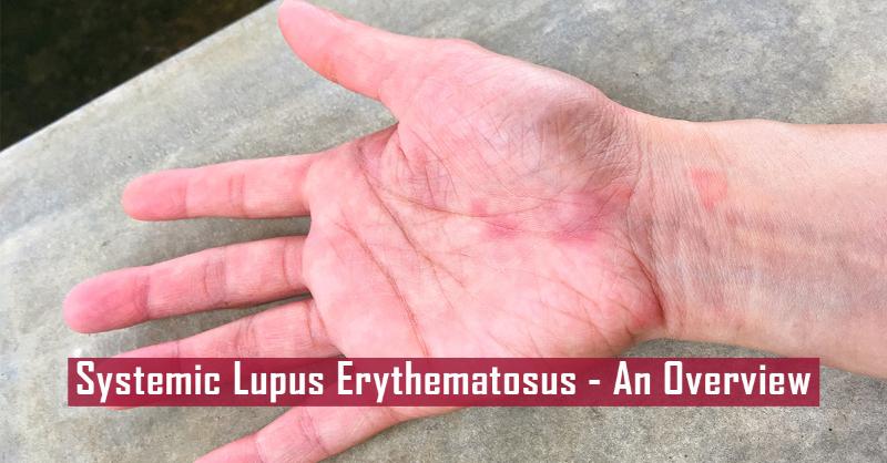 Elaboration of Autoimmune Disease: Systemic Lupus Erythematosus and Its ...
