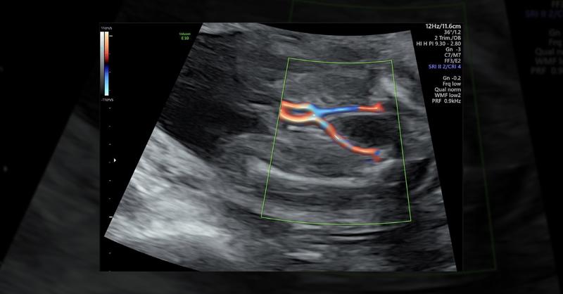 Diagnosis of Single Umbilical Artery and Fetal Demise in Multigravida ...