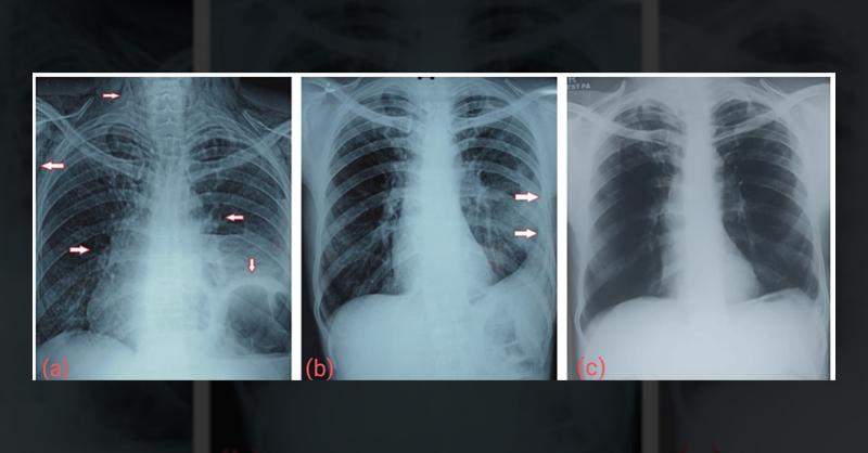 Diagnosis of Tuberculosis, Lung Abscess, and Subcutaneous Emphysema ...