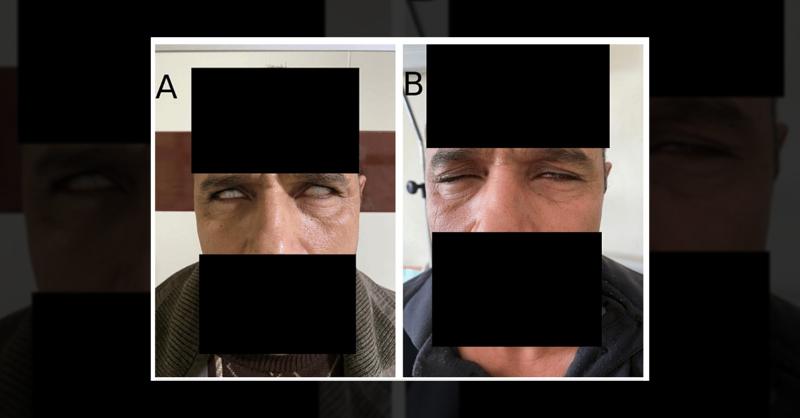 A Case of Isolated Bilateral Peripheral Facial Paralysis | MedSynapse