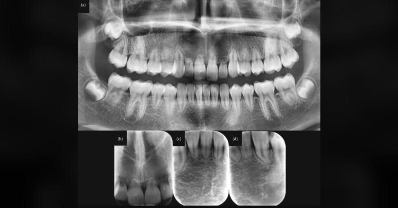 Generalized Short Roots Anomaly of Teeth in a Pediatric Patient ...