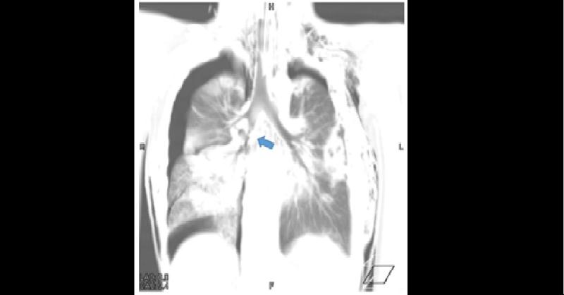 Management of Severe tracheobronchial injury in an 11-year-old boy in a ...