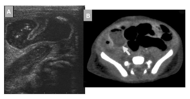 Neonatal Appendicitis Mimicking Intestinal Duplication | MedSynapse