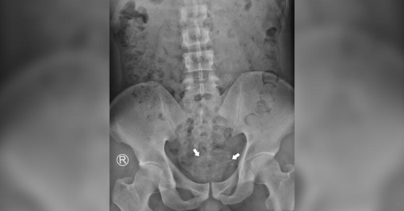 An Earphone wire inside the Urinary Bladder: A case report and ...