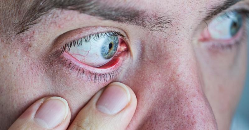 Voriconazole Corneal Intrastromal Injection For Fungal Keratitis ...