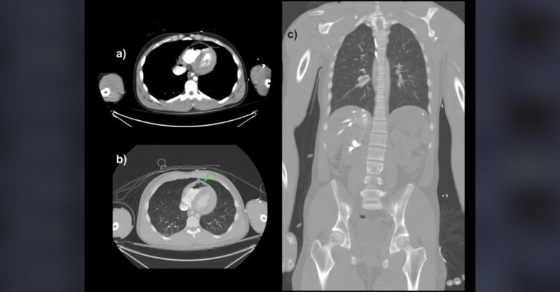 Extensive Systemic Vascular Air Emboli & Associated Cardiac ...