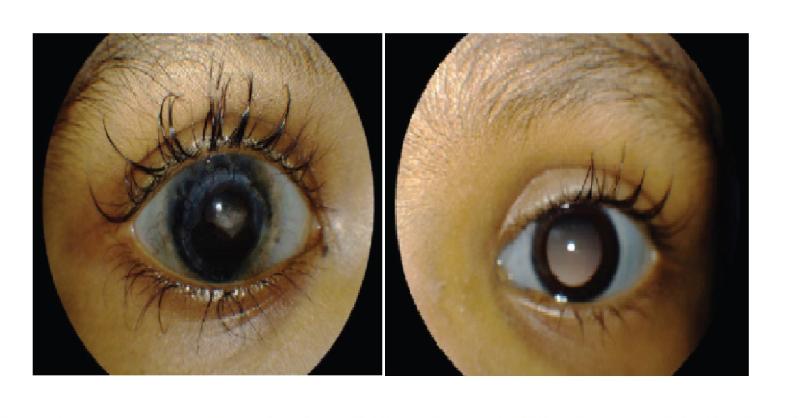 Rare Ophthalmic Manifestation Showing Bluish Sclera and Corneal ...