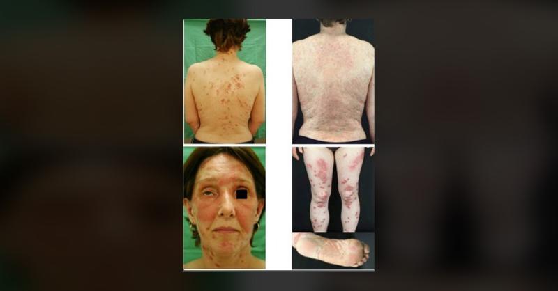Diagnosis of a Patient Presenting with Diffuse Skin Rash, Abdominal ...