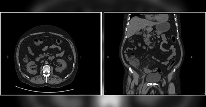 A Rare Case of Stump Appendicitis in a 66-year-old man | MedSynapse