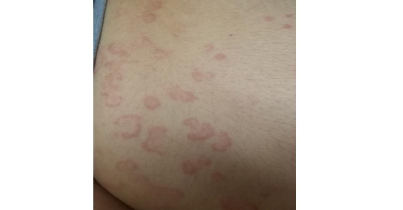 Treatment Approach fo Annular Erythema of Infancy | MedSynapse