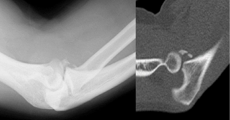 Identify The Appropriate Surgical Correction for a Coronoid Process ...