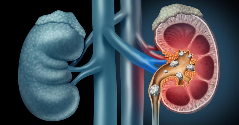 Flank Pain: Pyelonephritis or Urolithiasis in a 28-year male | MedSynapse