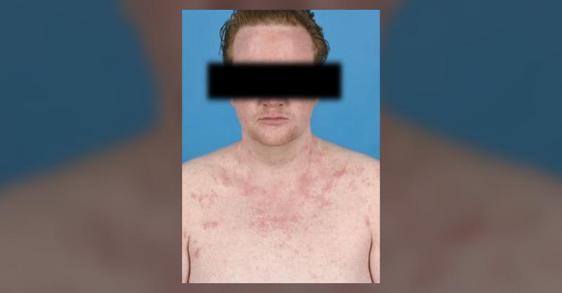 Dupilumab Drug-induced Adverse Skin Reaction in Atopic Dermatitis ...