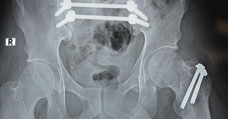 Extensive Overview of the Anterior Pelvic Ring Fixation System | MedSynapse