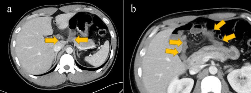 Internal Hernia Caused by Bridge Formation Between the Medial and ...