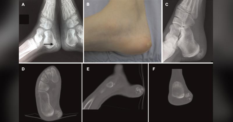 Unusual Bony Mass in the Hindfoot of a Teenage Girl | MedSynapse