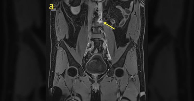 Intranodal US-Guided Methylene Blue Injection for Chylous Ascites ...
