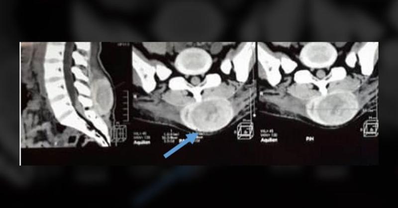 Possible Lumbar Morel-Lavallée Lesion in a Patient with Lower Back Pain ...