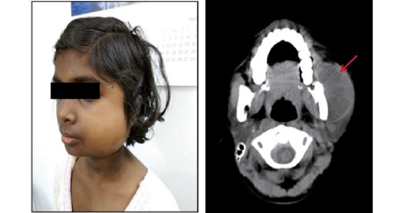 Rare Encounter of Parotid Region Swelling and Abscess in Young Girl ...
