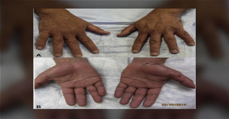 Rare Presentation of Acral Haemorrhagic Lesion of Darier Disease ...