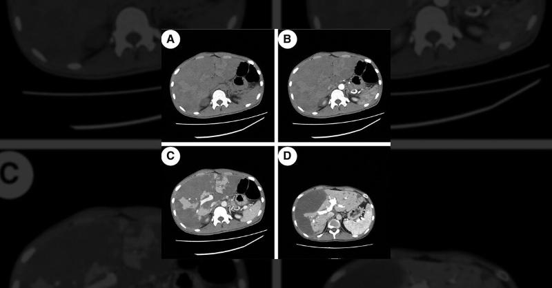 Identifying the Cause of Hepatic Artery Occlusion and Liver Infarction ...