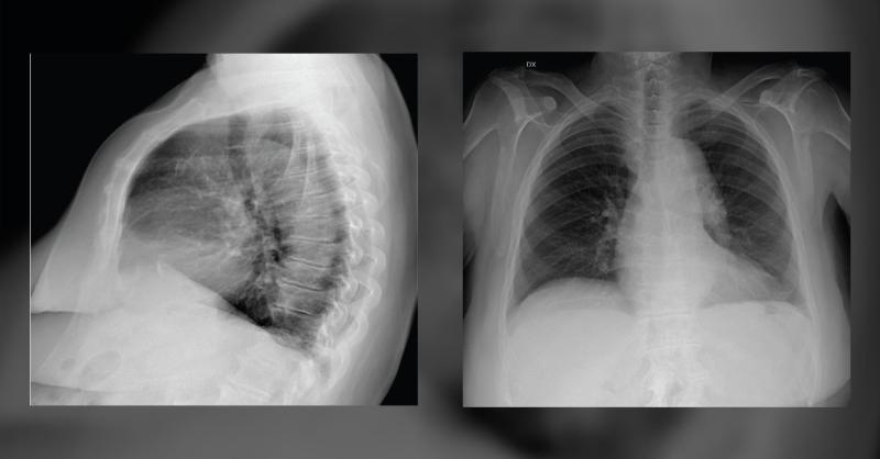 Bib Sign in Proximal Descending Thoracic Aorta Rupture on CT ...