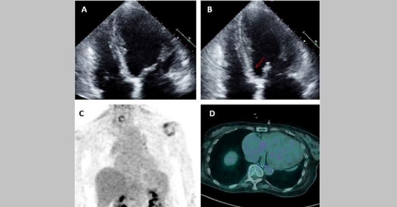 Case of Necrotizing myopathy presenting as congestive heart failure and ...