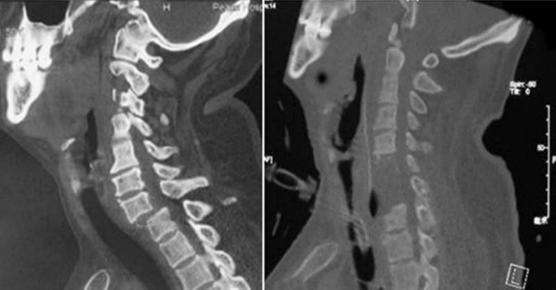 Diagnose Underlying Complication Through CT Images of This Patient ...