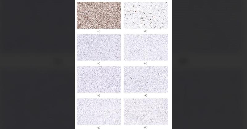 Diagnosis of a Patient with Refractory Crohn’s Disease and Small Bowel ...