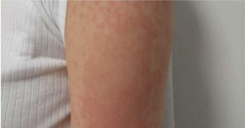 Diagnose Erythema in Woman after COVID Vaccine | MedSynapse
