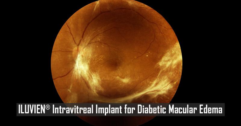 Intravitreal Implantation of ILUVIEN® for Patients with Diabetic ...