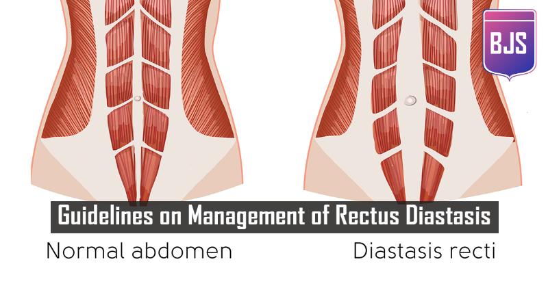 Guidelines on Management of Rectus Diastasis | MedSynapse