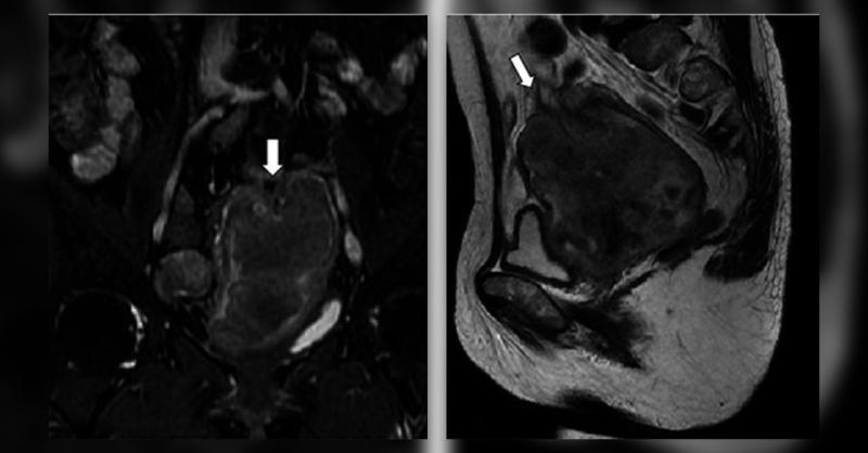 A Rare Case of Uterine Inversion in 67-Year-Old Woman | MedSynapse